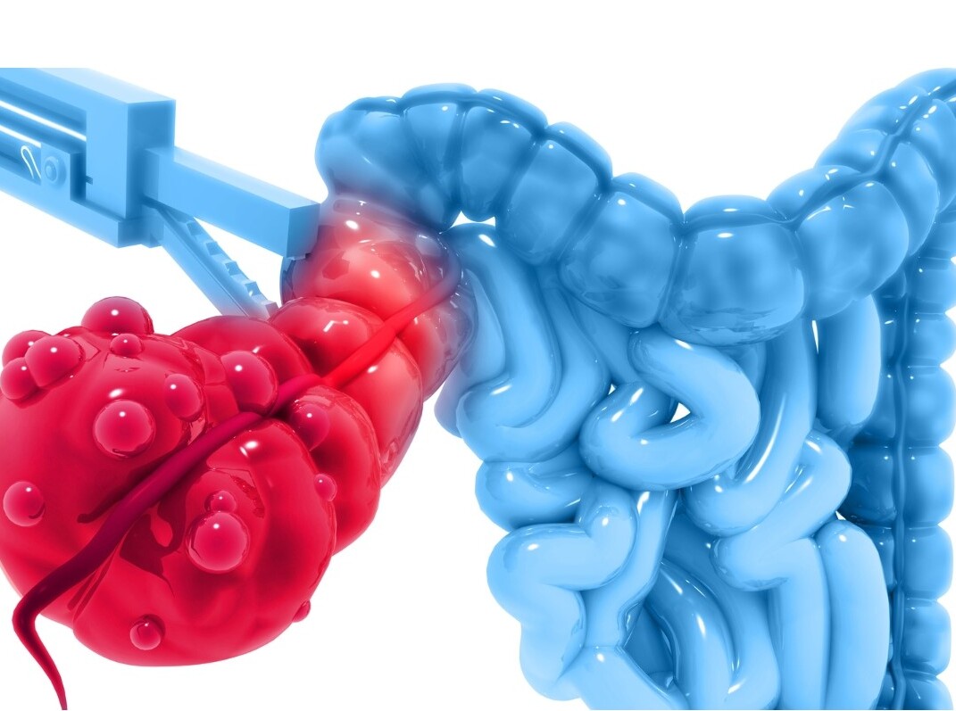 Appendix Removal Surgery Complications: Risks And Possible Side Effects - Gmoney.in